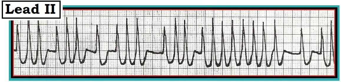 ECG Interpretation: ECG Interpretation Review #36: (WCT - VT - A Fib ...