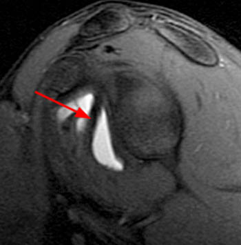 MRI Musculo-Skeletal Section: Glenohumeral ligaments