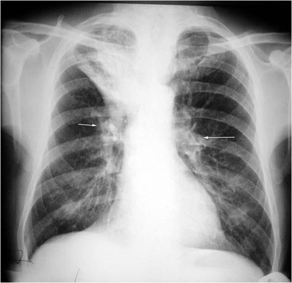 RADIOLOGY IMAGE SPOTTERS: Right upper lobe collapse