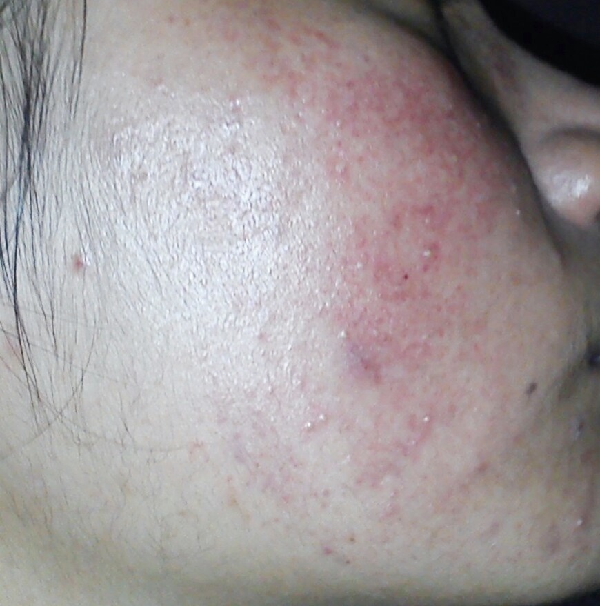 Pengalaman melakukan MTS (Micro Needle Theraphy System)