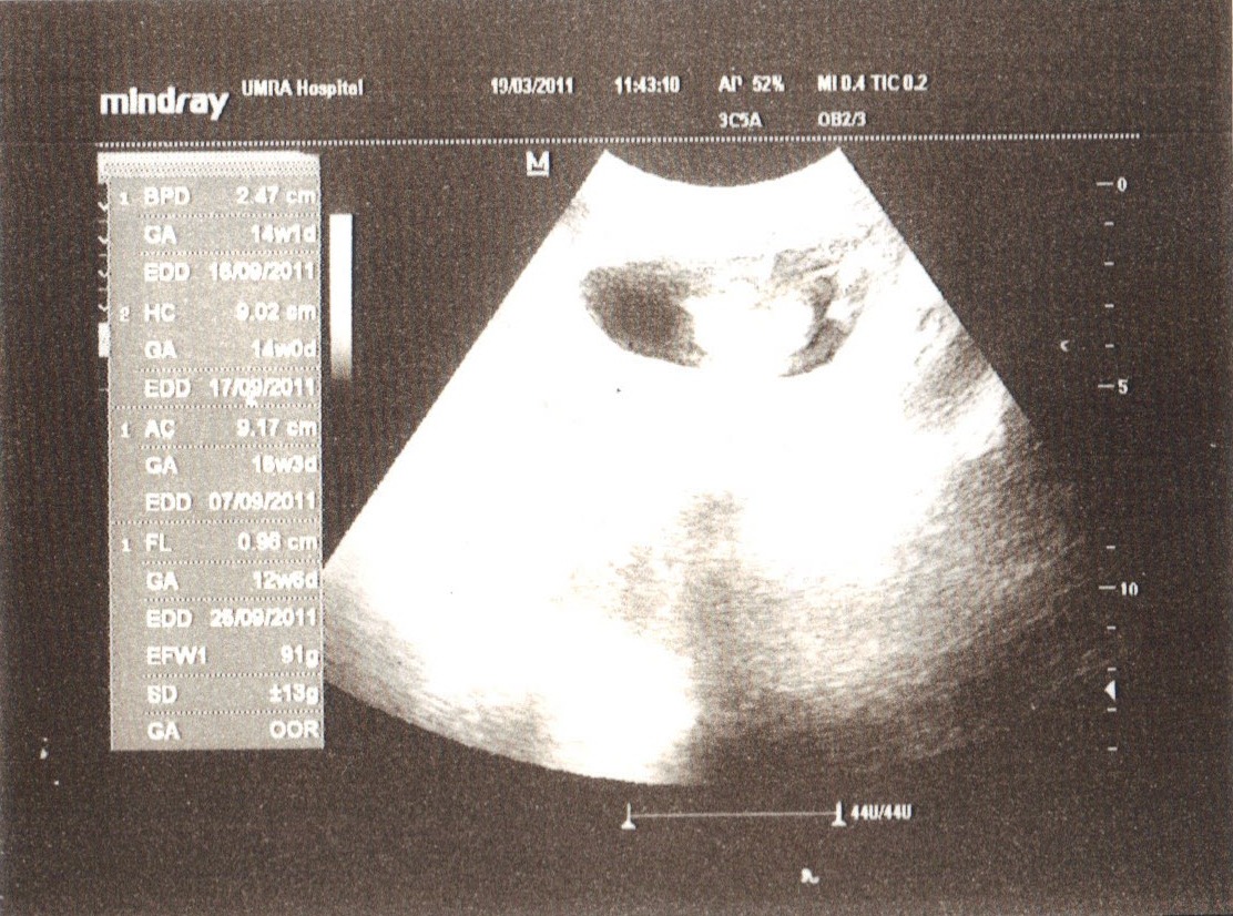 My Pregnancy Day and Progress...: Gambar scan babies...