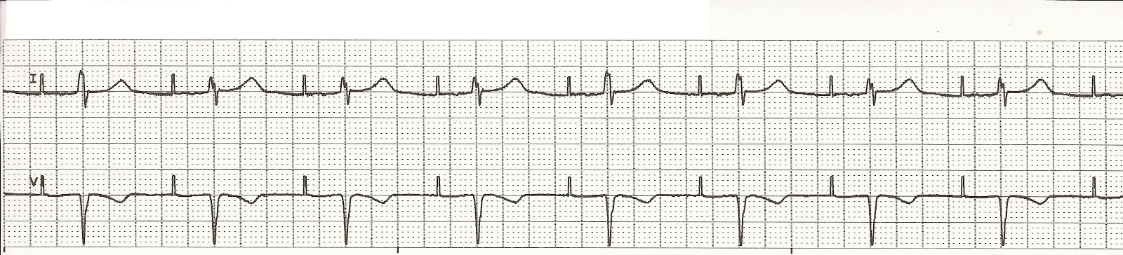 EKG Rhythm Strips 70
