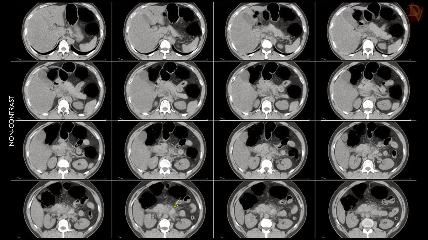 Ultimate Radiology : Acute Pancreatitis with hemorrhage and Pancreas ...