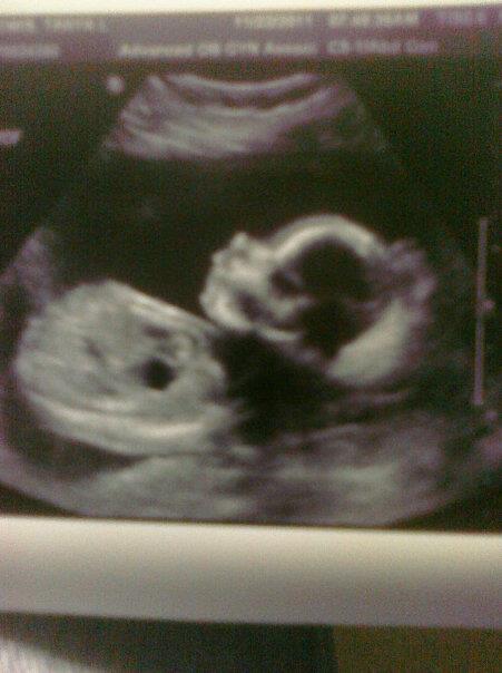 Mrs. Lewis' Learning Library: An Update on our Baby! Prayers please....