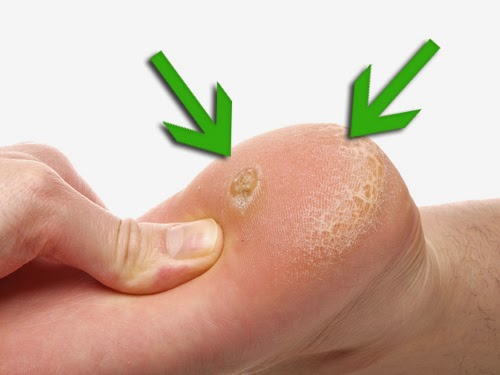 CONSEJOS QUE AYUDAN A PREVENIR LA APARICIÓN DE CALLOSIDADES EN LOS PIES ...