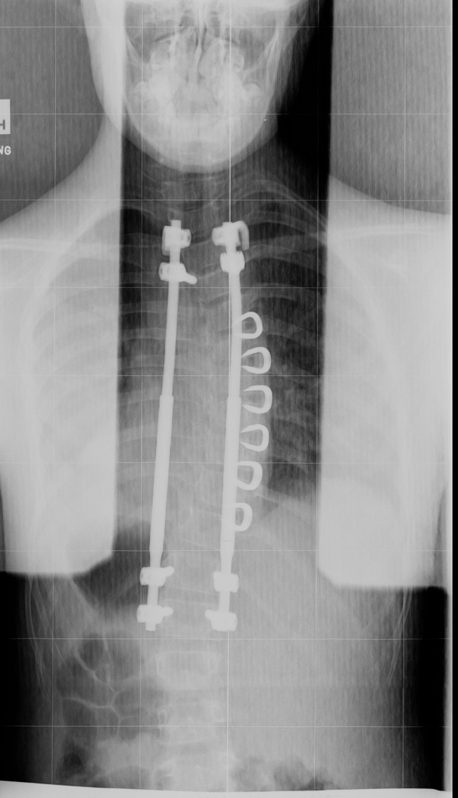 Life with Beals: Surgical Options