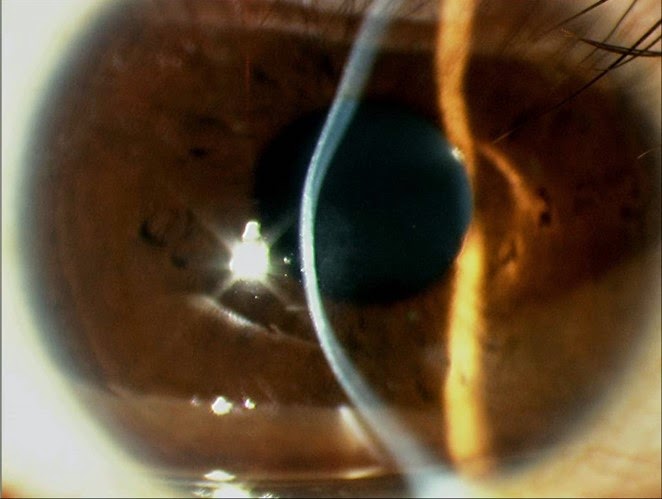 All things eye | Por Yong Ming: Keratoconus-a conical corneal conundrum
