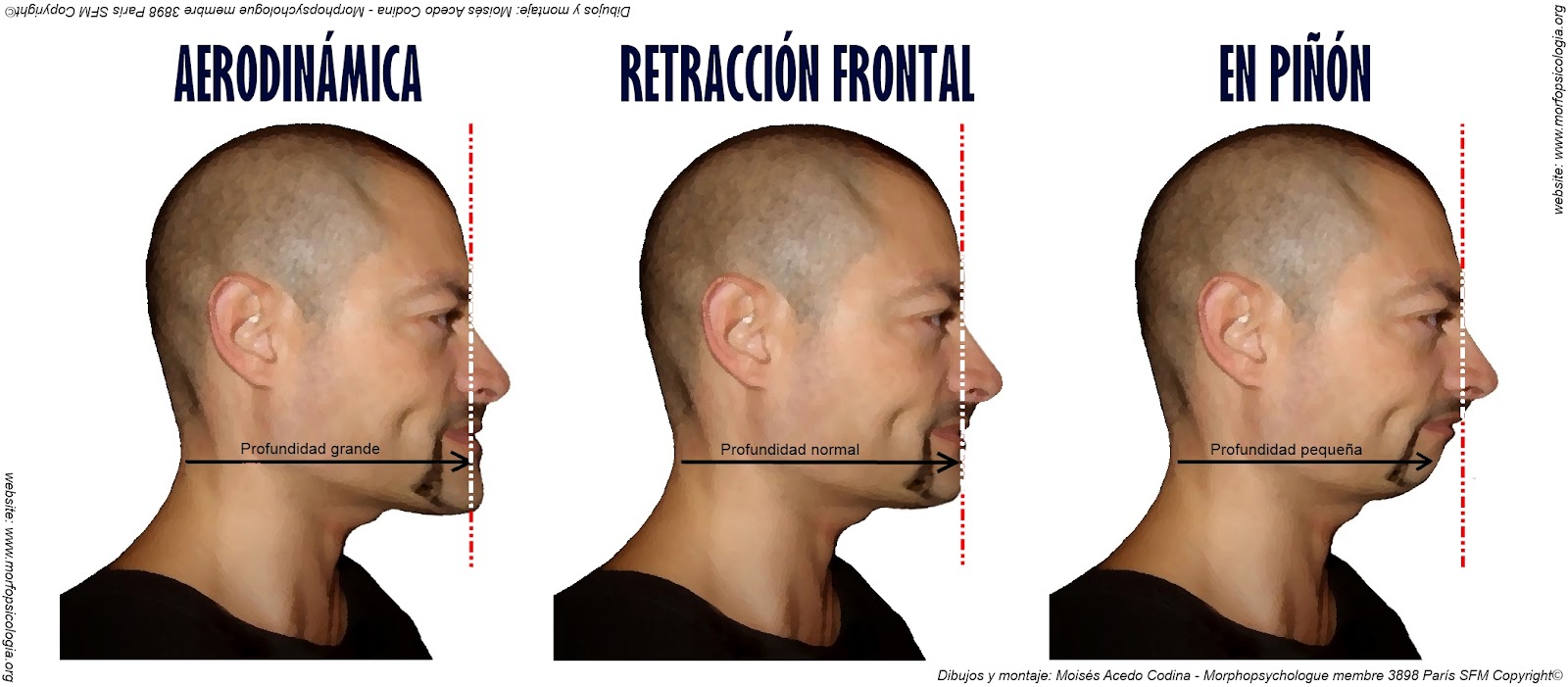 Moisés Acedo Codina: PROYECCIÓN DEL MENTÓN: EL EMPUJE