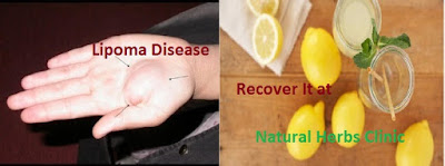 Lipoma Treatment: Lipoma Natural Treatment