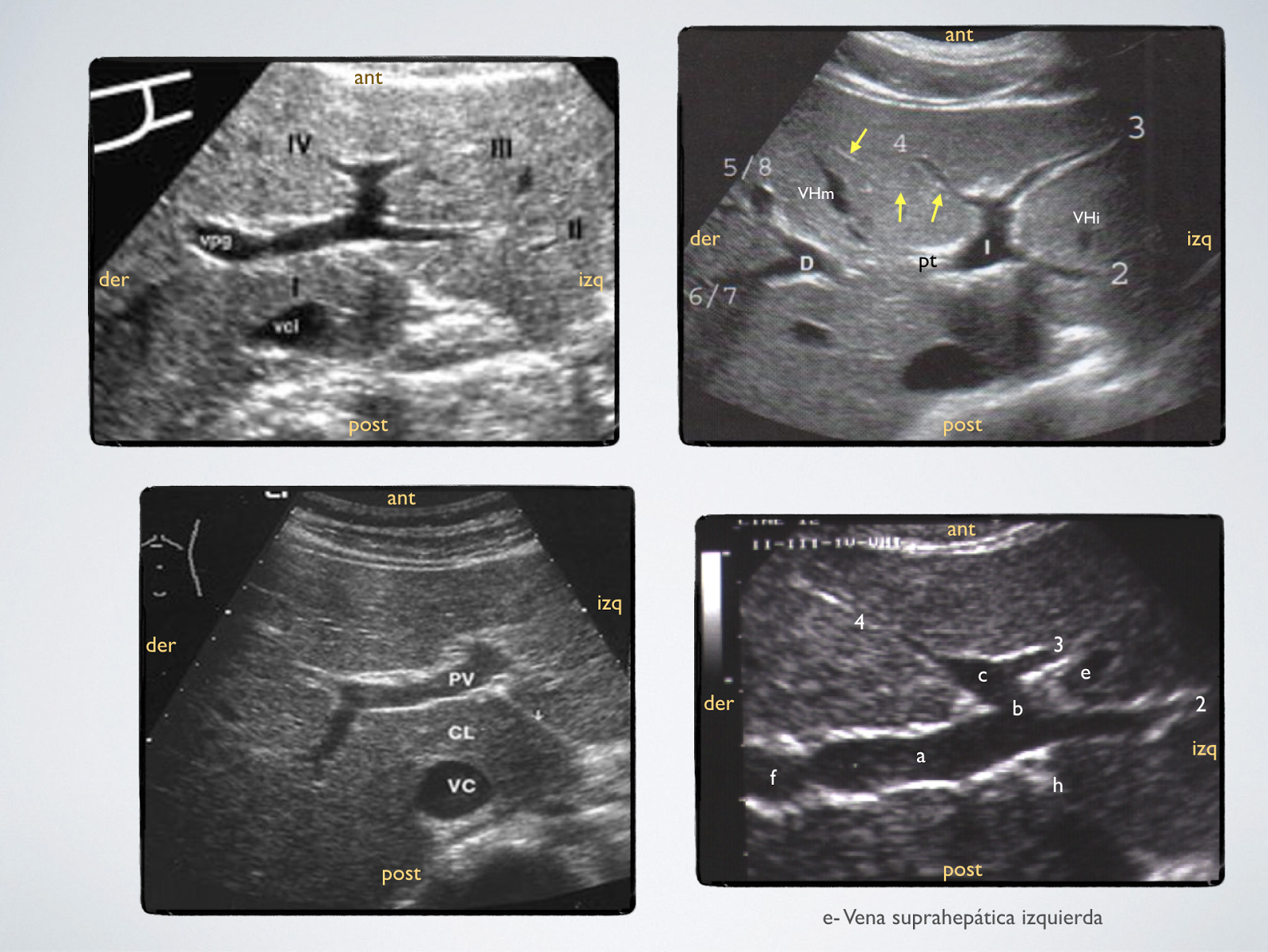 Cuadernos de Anatomía Quirúrgica: Segmentación hepática en ecografía.