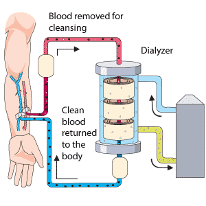 treatment for kidney disease: Dialysis is needed in end-stage Renal Failure