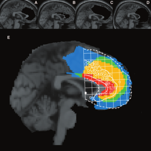 Andy's Brain Blog: Lesion Studies: Thoughts