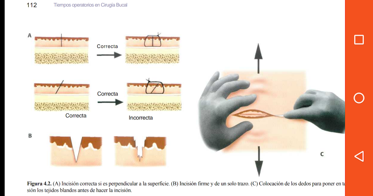 FUNDAMENTOS DE ANESTESIA Y EXODONCIA : INCISIONES Y SUTURAS