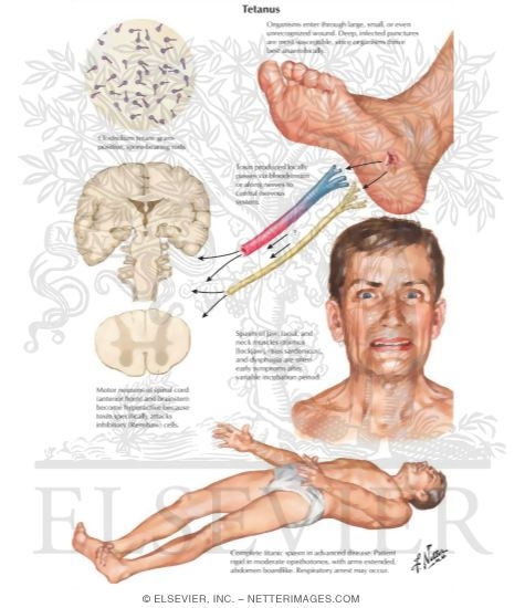 The Stories of Ester: Tentang TETANUS