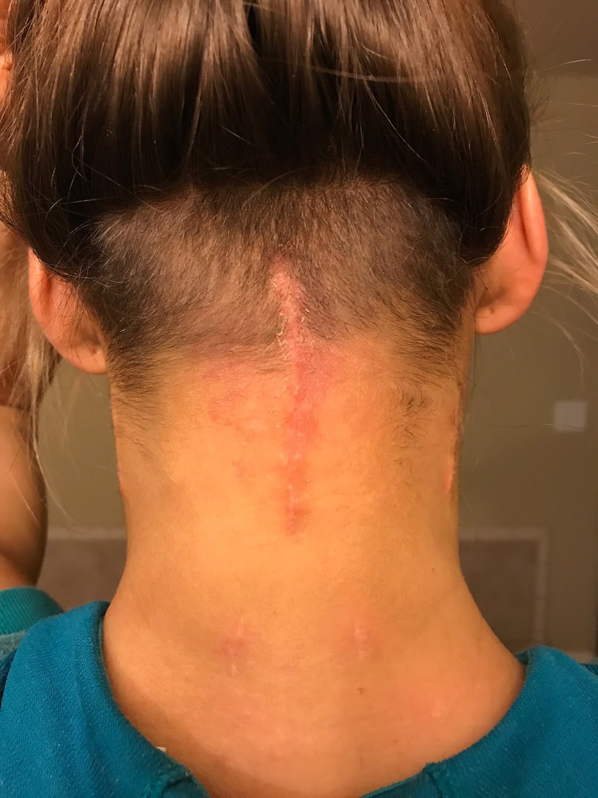 ...but maybe tomorrow: 2 weeks post occipital nerve decompression and ...