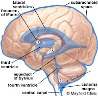 Walter's Hydrocephalus Education blog: Absence of the Aqueduct of of ...