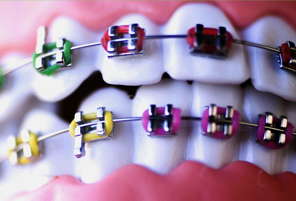 Qué hábitos debés cambiar al ponerte brackets | Directorio Odontológico