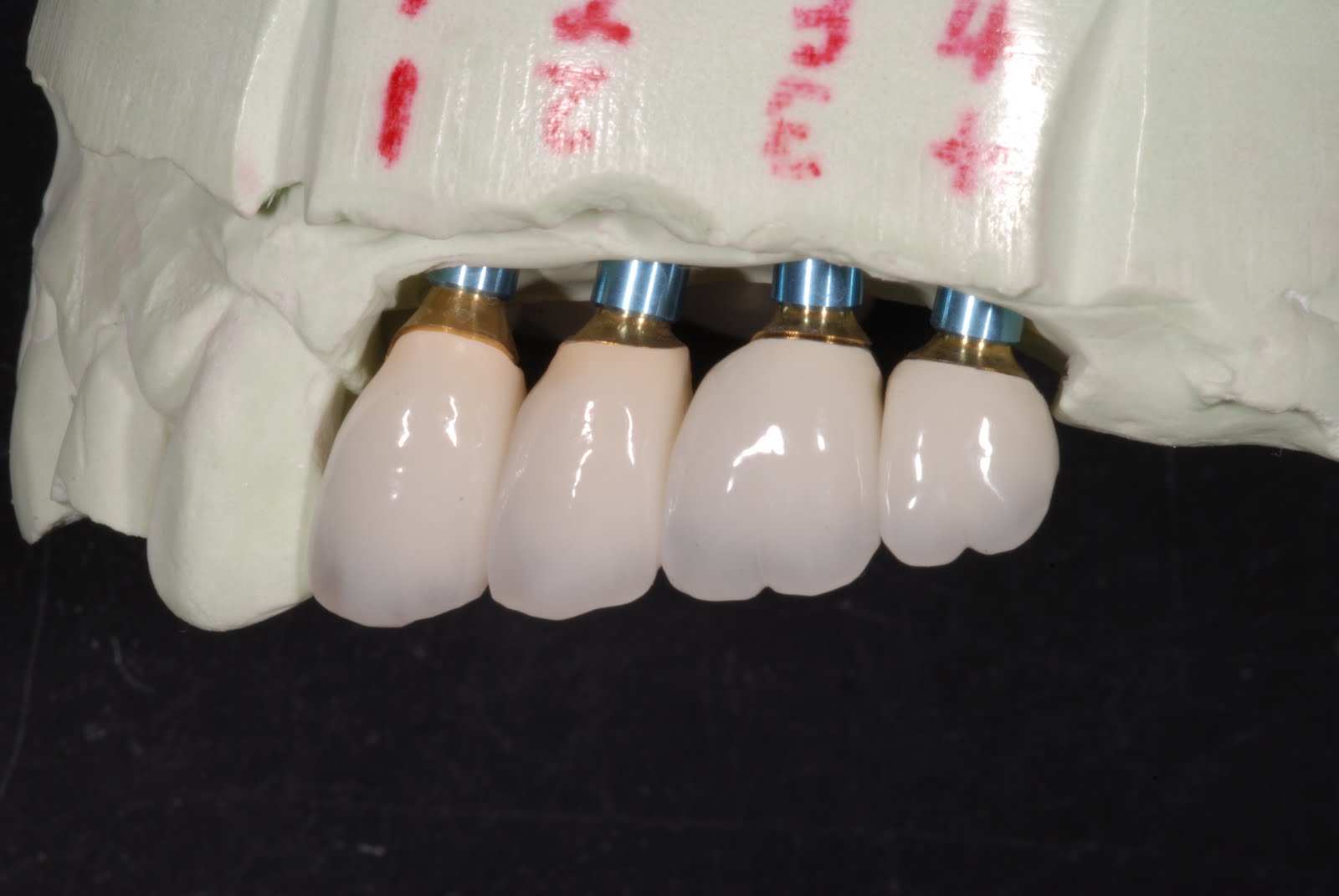 Dental Implants Experience: My Laboratory work is complete