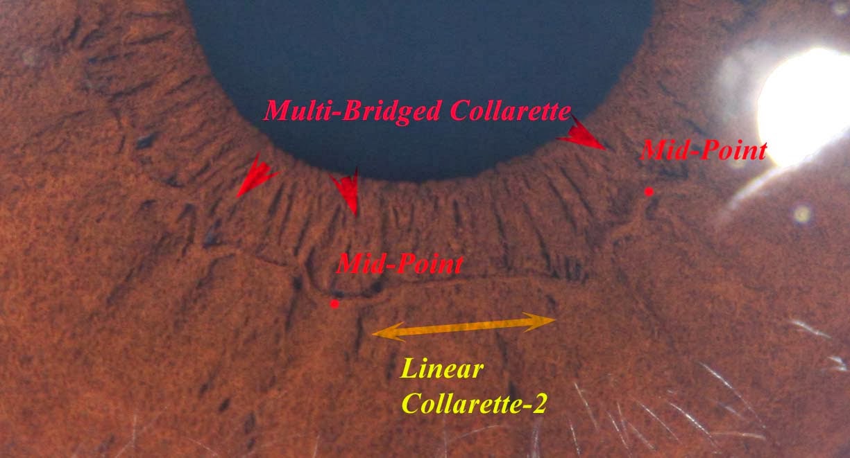 Modern & Multidimensional Iridology: The Collarette Structure in Modern ...