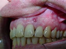 DRA DEISE BASTOS: FÍSTULA DENTÁRIA