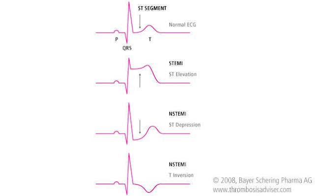 STEMI vs NSTEMI