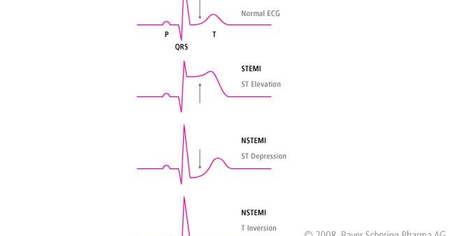 STEMI vs NSTEMI