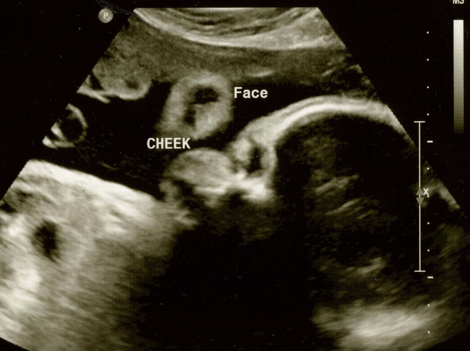 35 Week Ultrasound Boy