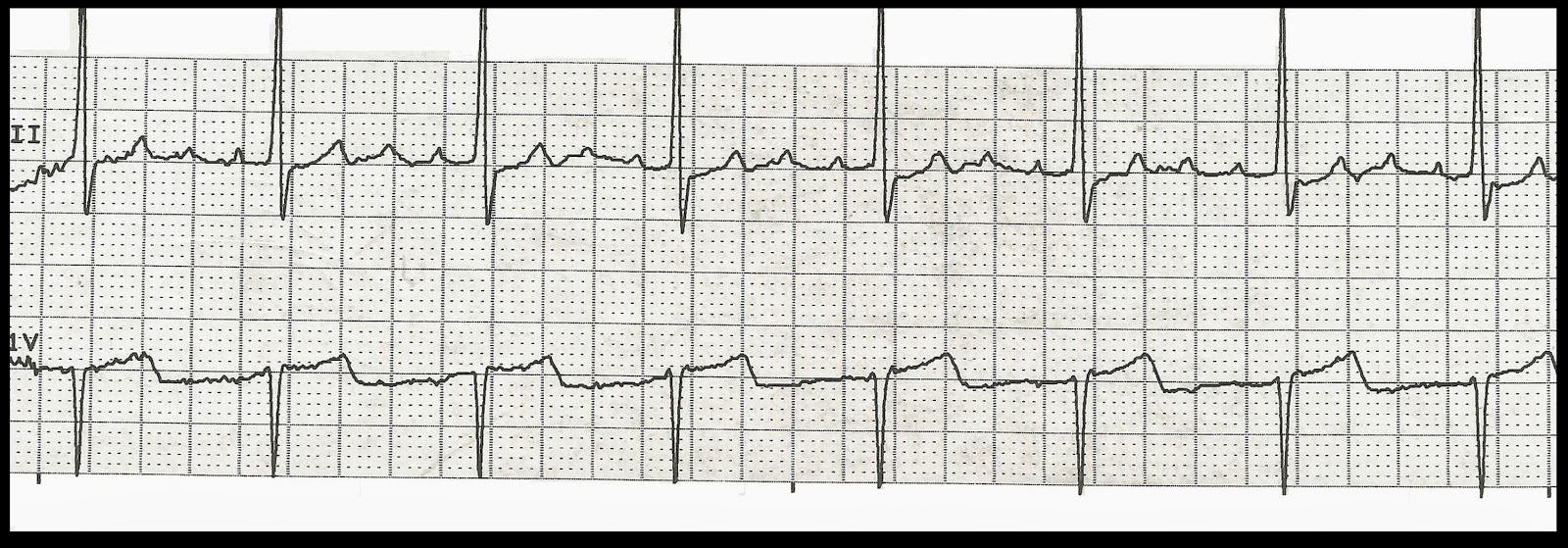 EKG Rhythm Strip Quiz 187