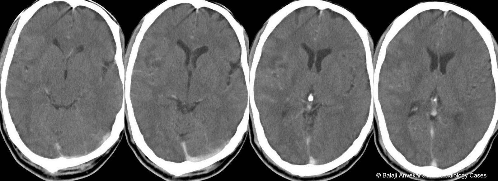 Dr Balaji Anvekar FRCR: Post TBM Vasculitis induced infarcts