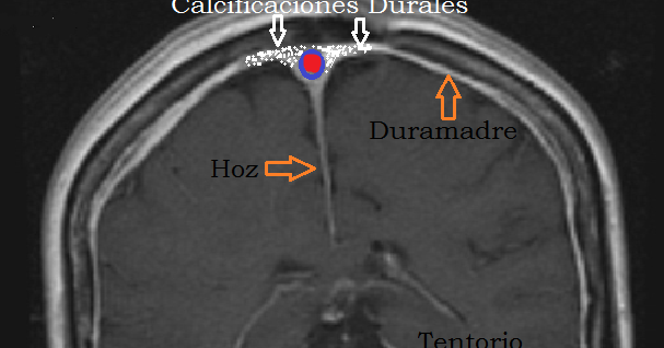 El Baúl Radiológico: CALCIFICACIONES DURALES EN TOMOGRAFÍA ...