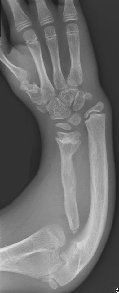 Type 2 Radial Longitudinal Deficiency | Congenital Hand and Arm ...