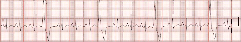 EKG Rhythm Strips: Bigeminy, Trigeminy, Quadrageminy