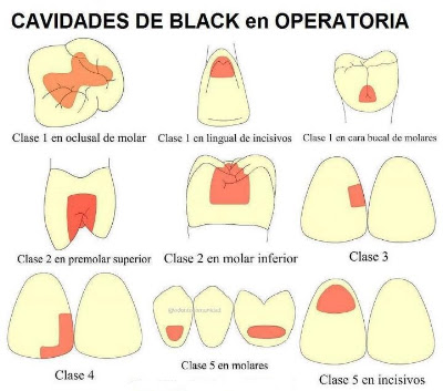 CENTRO ODONTOLÓGICO JUAN GODOY: clasificacion de black caries