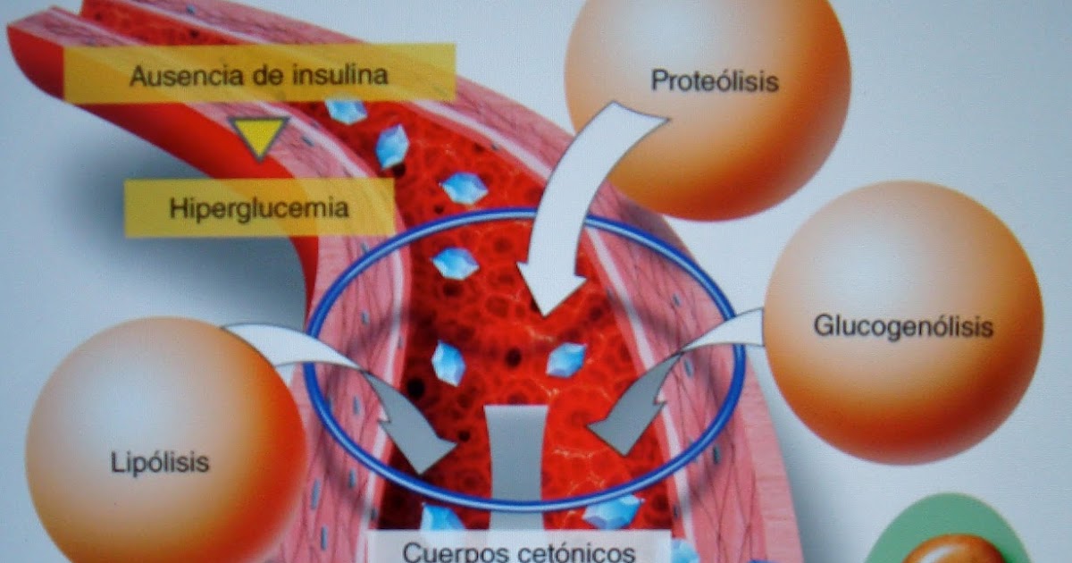 Cetoacidosis diabética | Casa del diabético Vidabetic - viviendo con ...