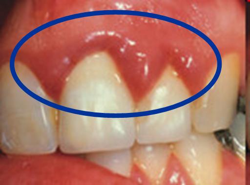 SEMIOBLOG: Repercussões Sistêmicas da Doença Periodontal
