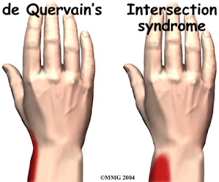 Physical Therapy DataBase: de Quervain's Tenosynovitis - Part II