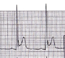 Doc Cottle's Desk: Benign early repolarization