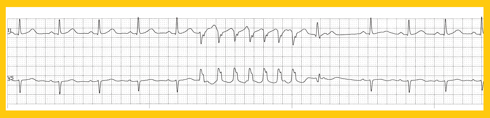 Various Ventricular Tachycardias