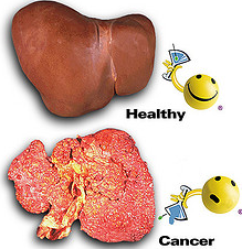 Types of Liver Cancer