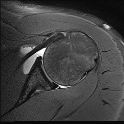 Radiology Cases: Peripheral Vertical Longitudinal Tear Posterior Labrum