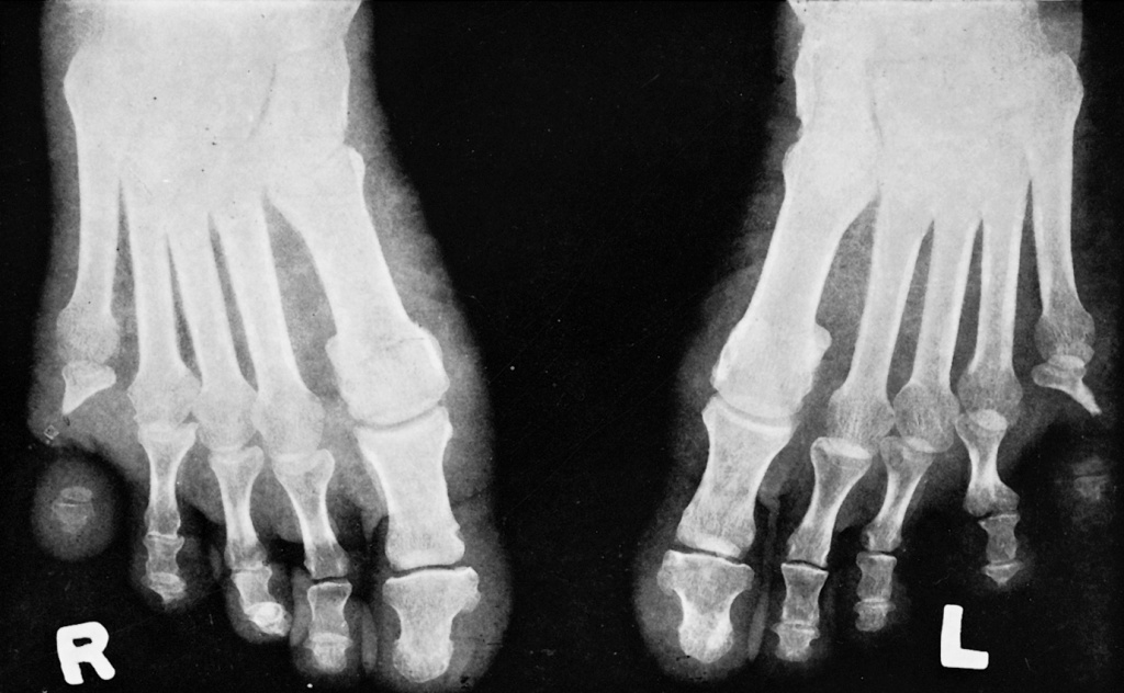 Dactylolysis Spontanea – A Bizarre Autoamputation Disease