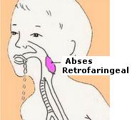 Pengobatan Abses Retrofaringeal | Pengobatan Penyakit Tbc Tulang