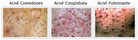 Estética e Autoestima: Tipos de Acnes e Tratamentos