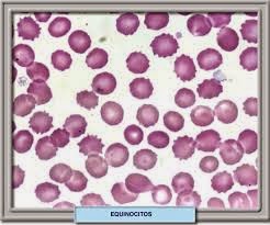 fichero hematologia: acantocitos