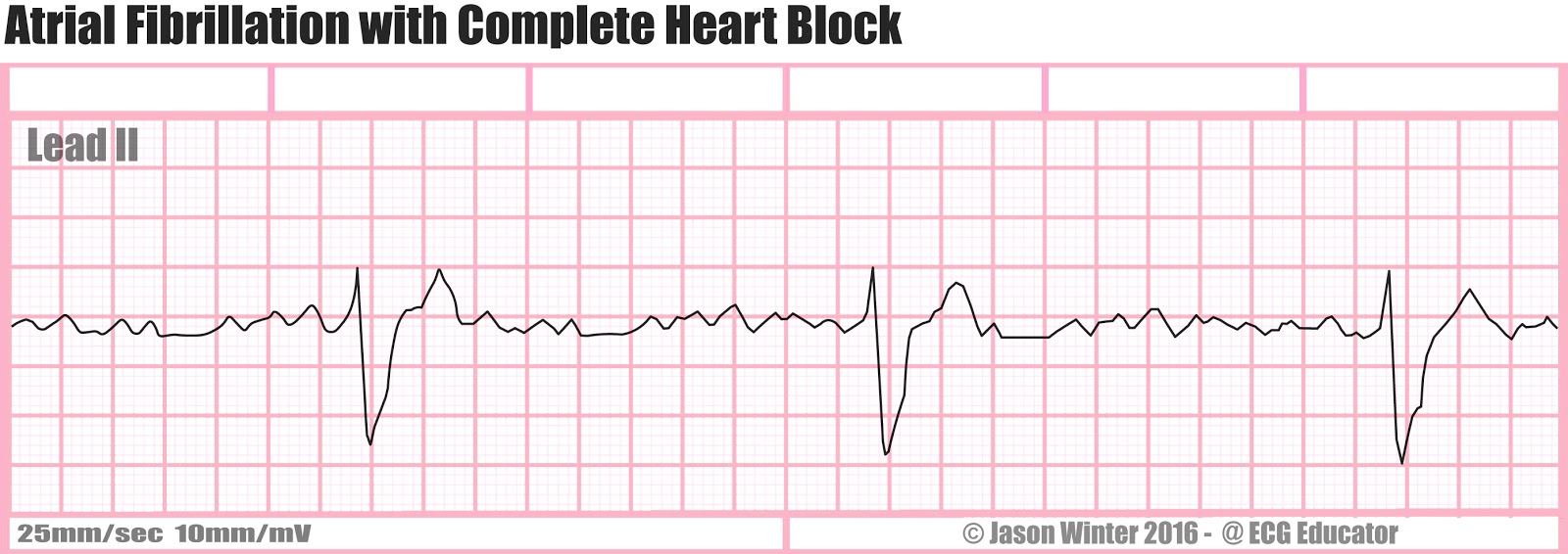ECG Educator Blog : Six Second ECG Rhythm Strips