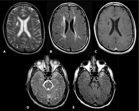 Image Bank: CADASIL MRI