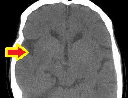POINT OF VIEW: DX: Acute-hyperacute stroke of the right MCA, M2 territory