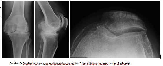 KLINIK ONLINE BEDAH ORTHOPAEDI: Nyeri Sendi Lutut (Osteoarthritis) part ...