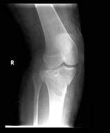 Tibia Plateau: Tibia Plateau breuk