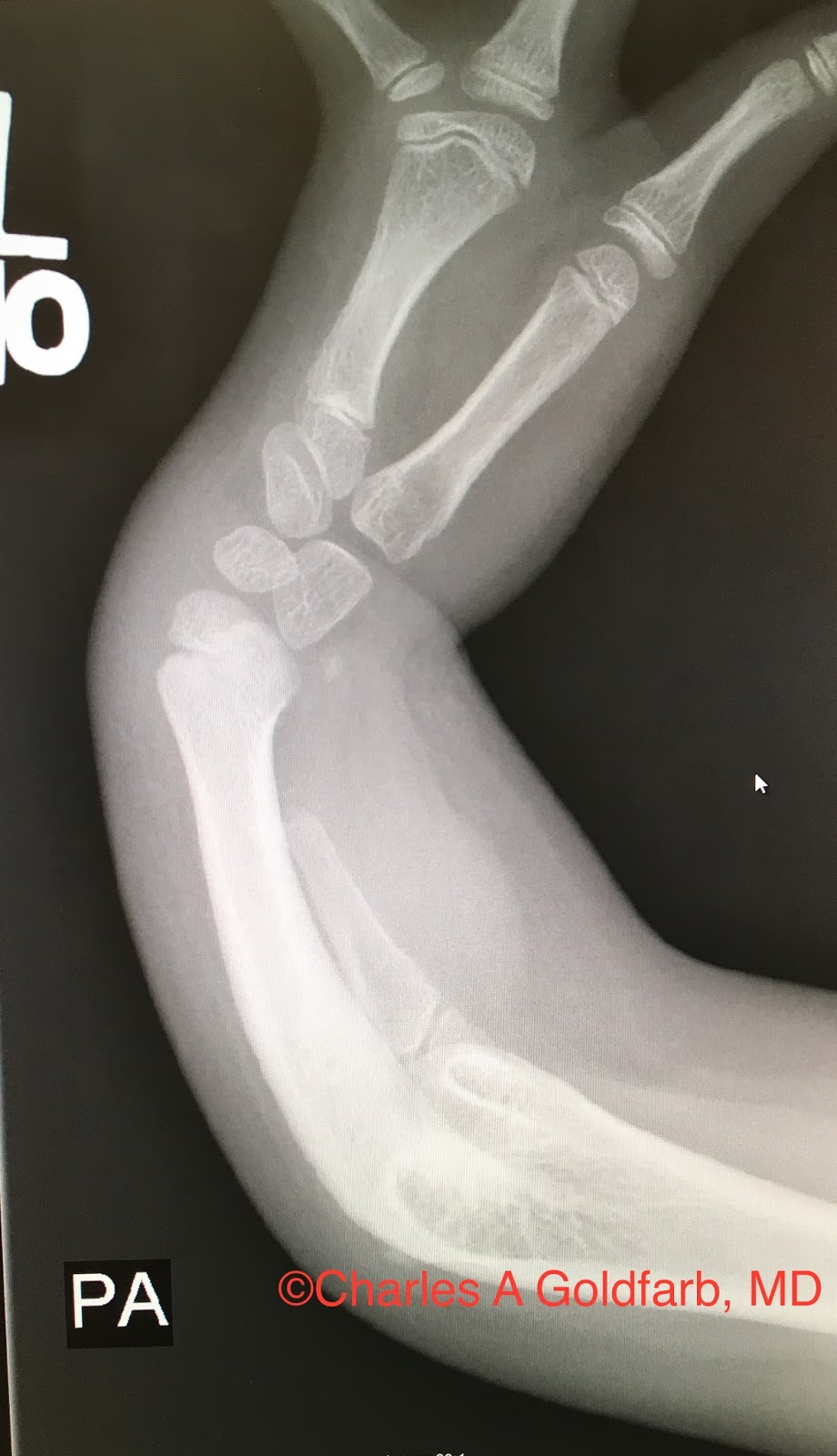 Ulnar Deficiency Follow Up | Congenital Hand and Arm Differences ...